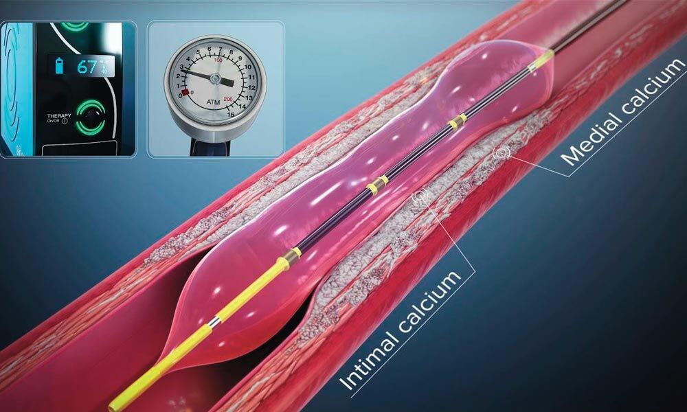 IVL proves boon for doctors to treat calcified coronary blocks