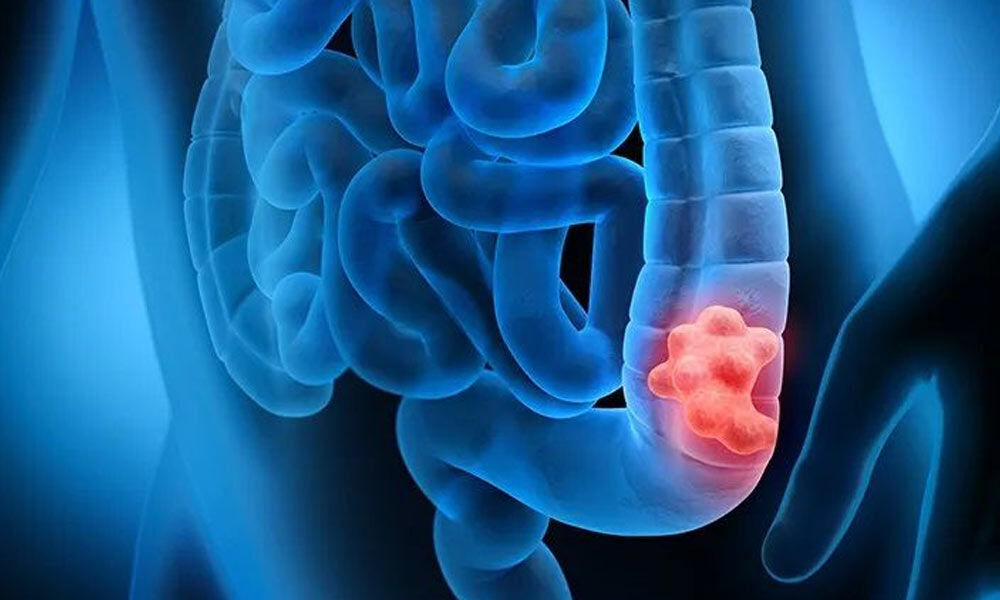 Bengaluru: Doctors perform rare multivisceral resection surgery on ...