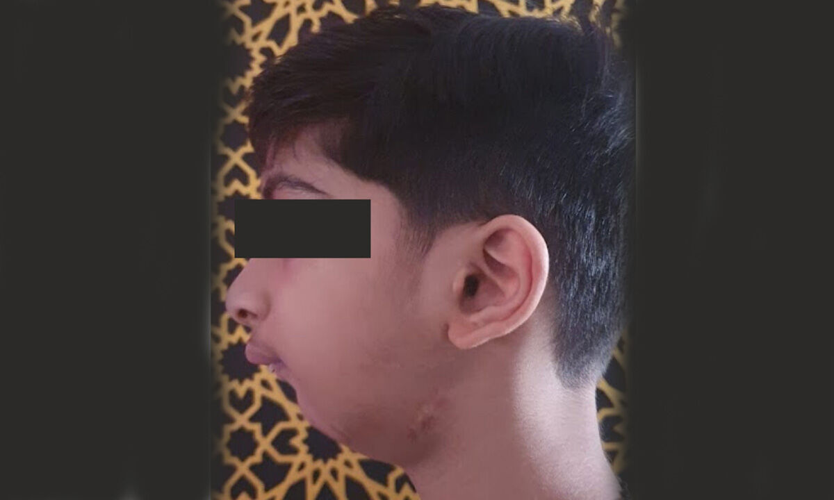 10-yr-old with dentofacial deformity treated successfully