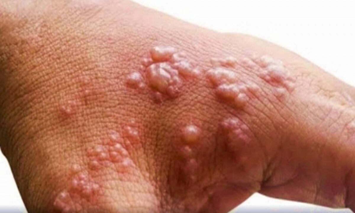 Study reveals safety, efficacy of tecovirimat in treating monkeypox