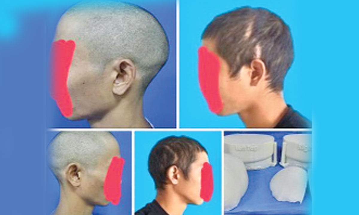 27-year-old's head deformity set right with cranioplasty