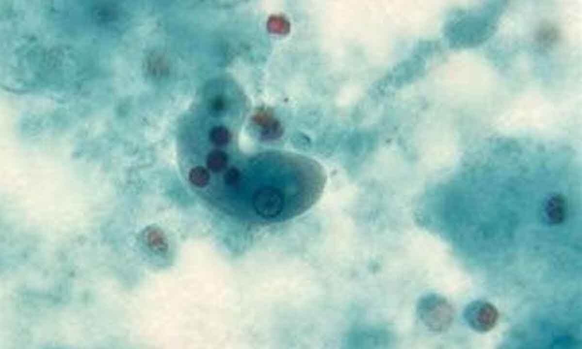 Naegleria Fowleri, an Brain eating Amoeba : First known infection ...