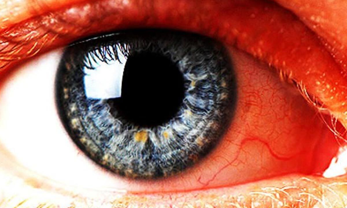 Doctors witness surge in thyroid eye disease post- pandemic