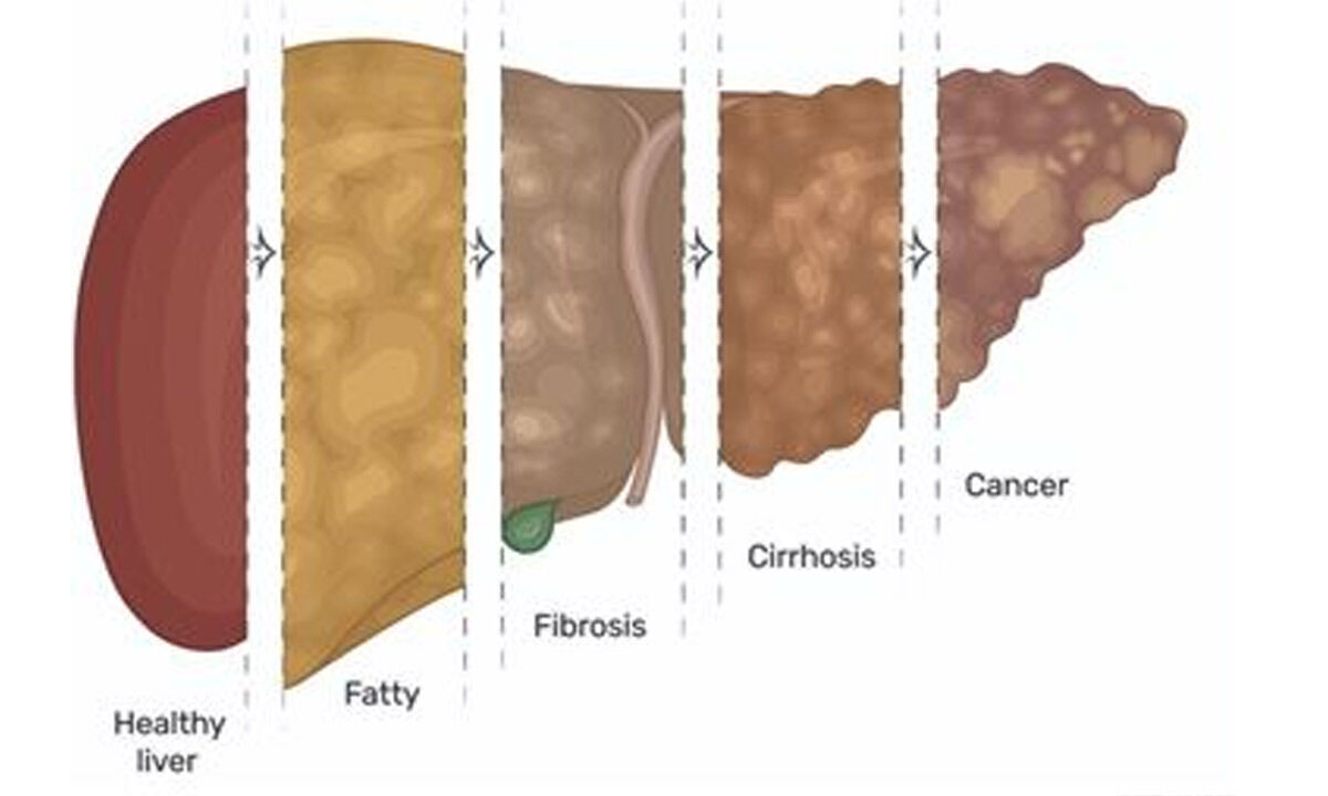 let your liver live long