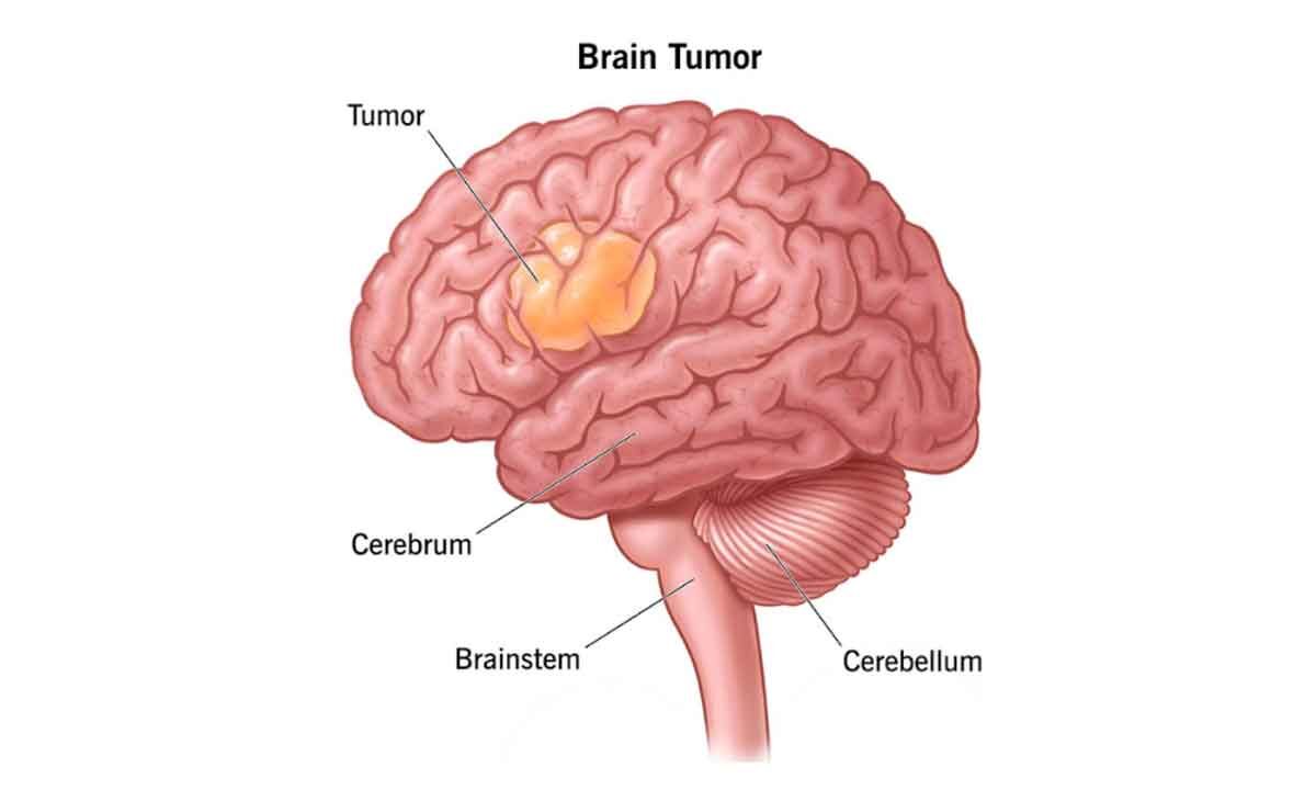 World Brain Tumor Day: Types, affects, symptoms & treatment