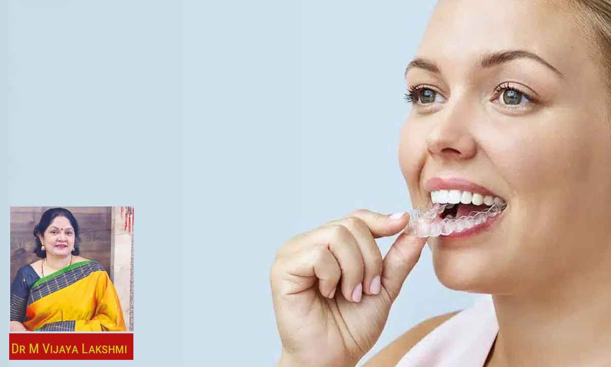 Dental straightening with Teeth Aligners: A modern approach to ...