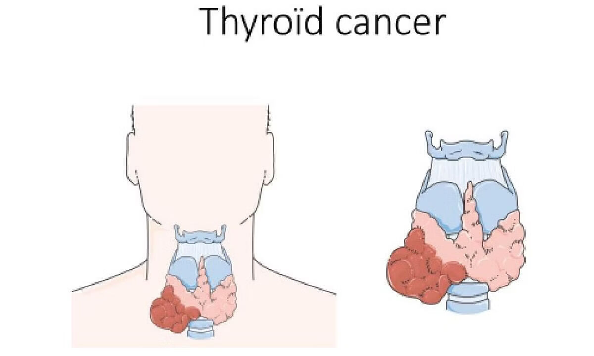 Youngest patient in India to undergo procedure for thyroid cancer