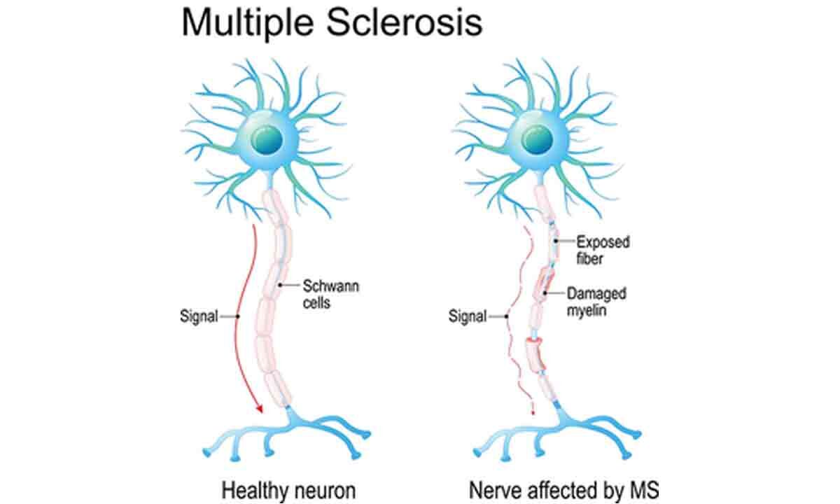 New Stem Cell Therapy May Halt Multiple Sclerosis Progression 0104