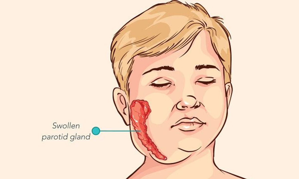 Parents beware, Mpox disease spreading among children