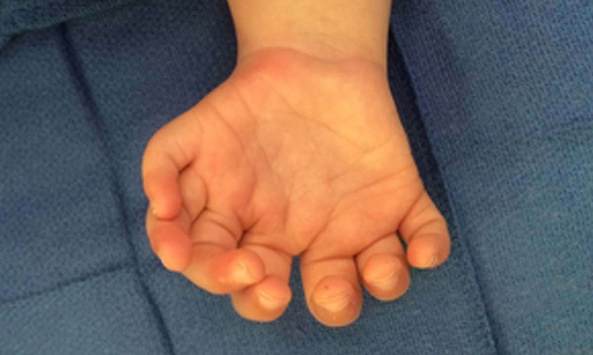 Study finds rare disorder behind extra fingers and toes