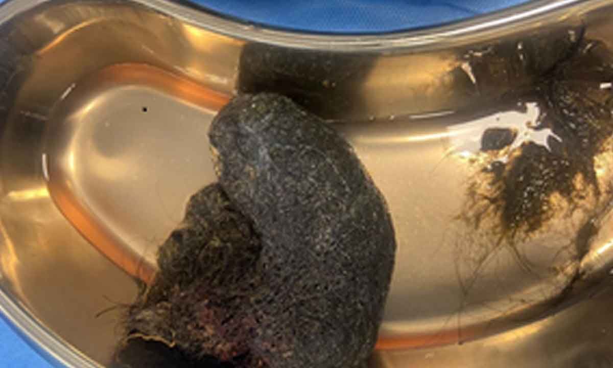 Doctors remove cricket ball-sized hairball from 8-year-old’s stomach