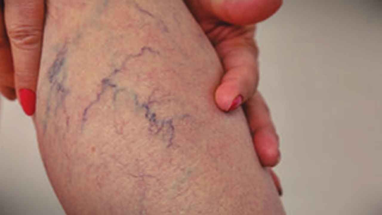 Ice-cold feet and heaviness in legs? It may signal varicose veins, says ...