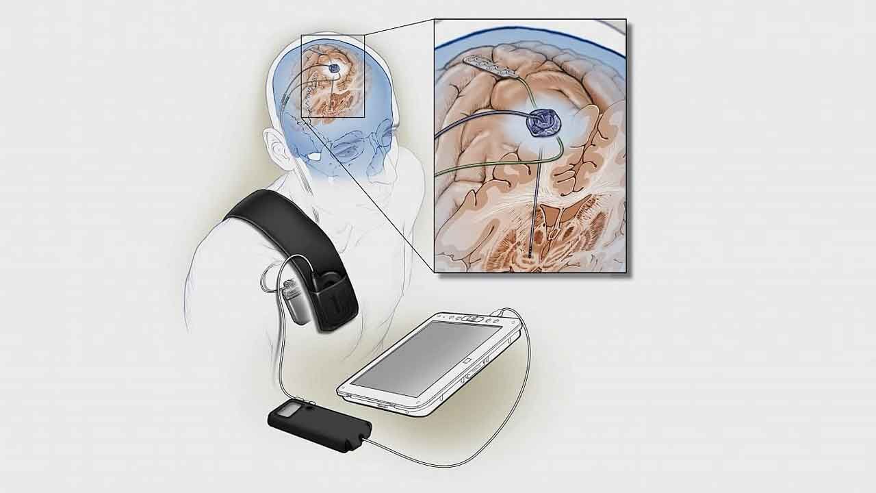 Brain implants that are helping people with Parkinson’s
