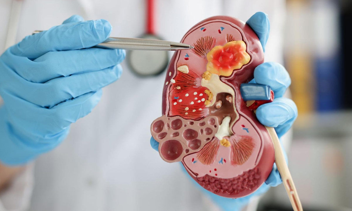 The Salt-Kidney Stone Link: How to Lower Sodium