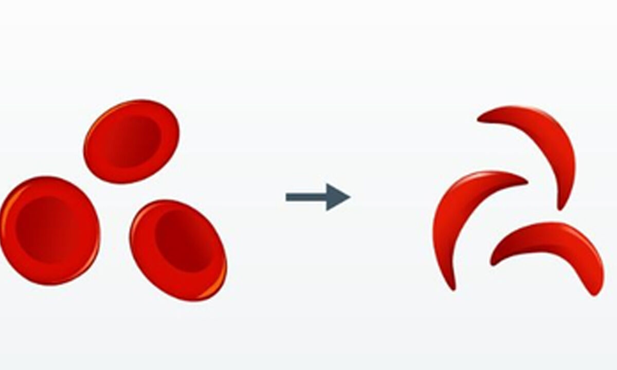 Sickle Cell elimination mission tackling genetic disorder to ensure ...