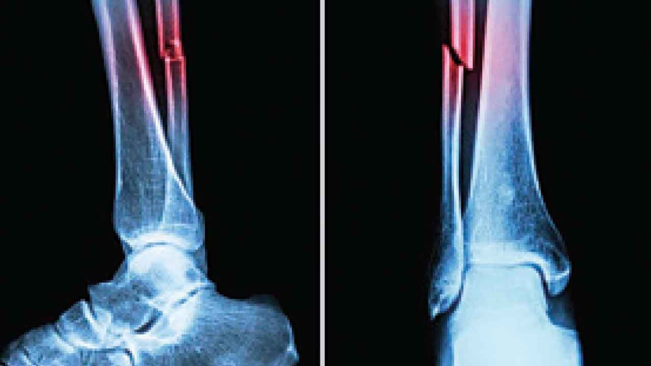 NIT Rourkela study to boost bone regeneration technology