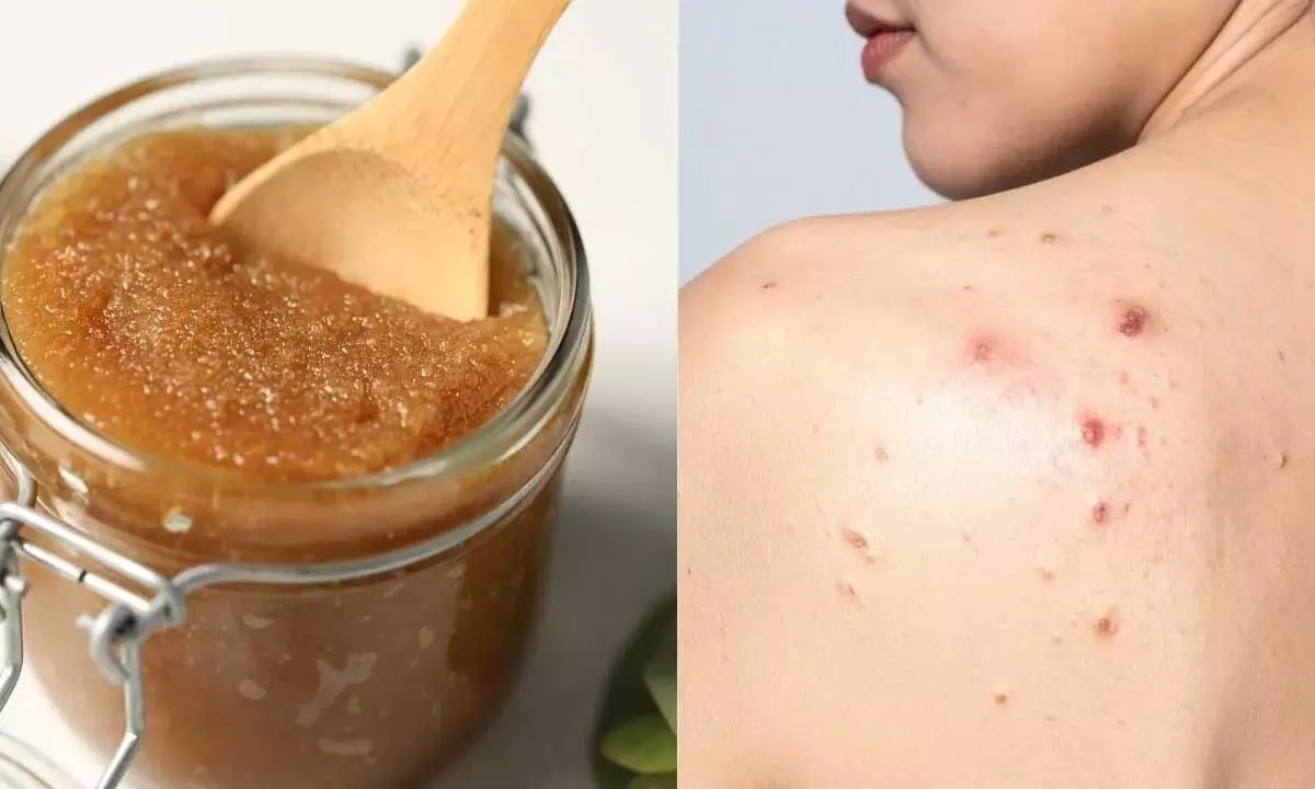 Natural DIY Body Scrubs To Fight Body Acne And Reveal Clear Skin