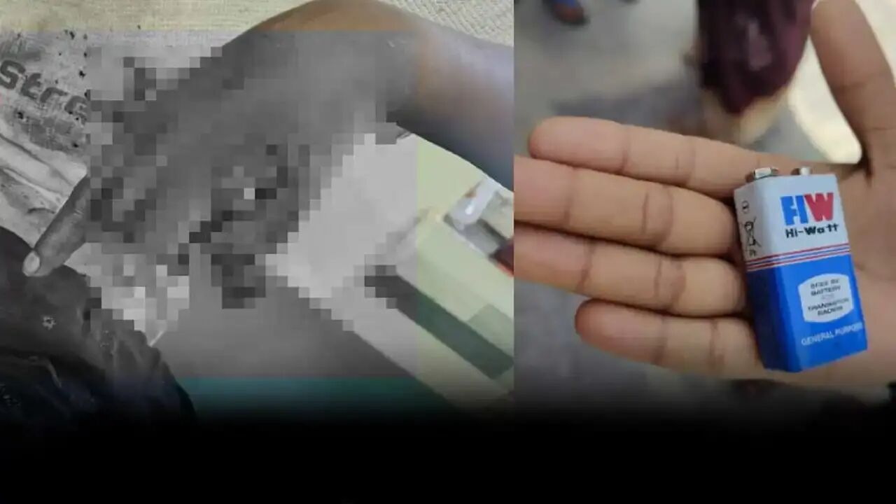 Battery explosion severes boy’s fingers in Medak district